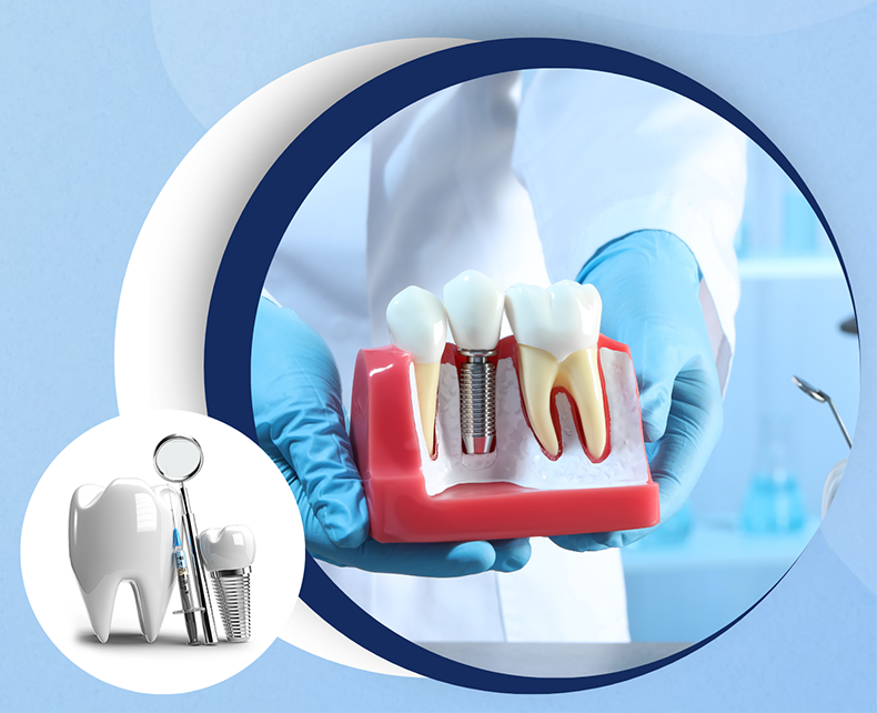 All-on-Four Dental Implants - North Miami Dental Group